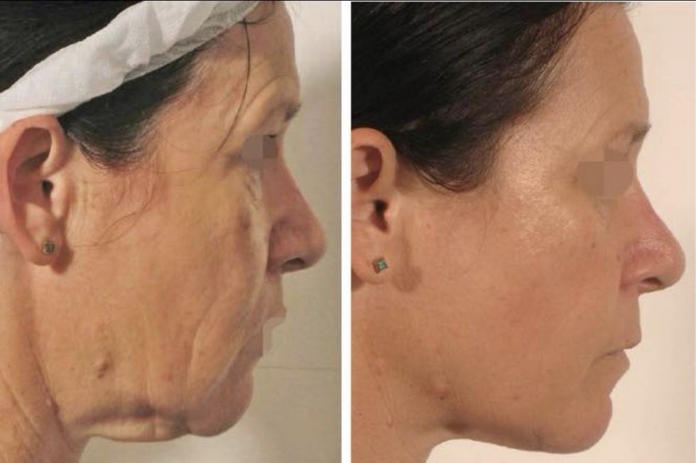 LipoFirm Pro Face | iNkfish - Hair • Beauty • Body